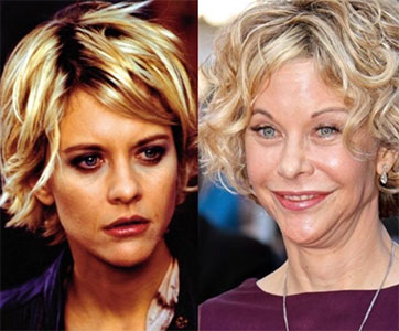 Explaining "Overfilled" Cheeks - Cangello Plastic Surgery