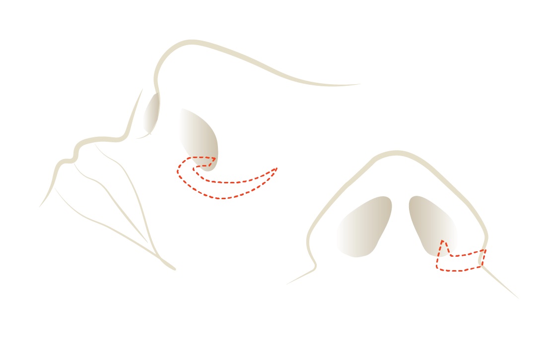Nasal Base Reduction New York City NYC | Alar Base Narrowing Manhattan