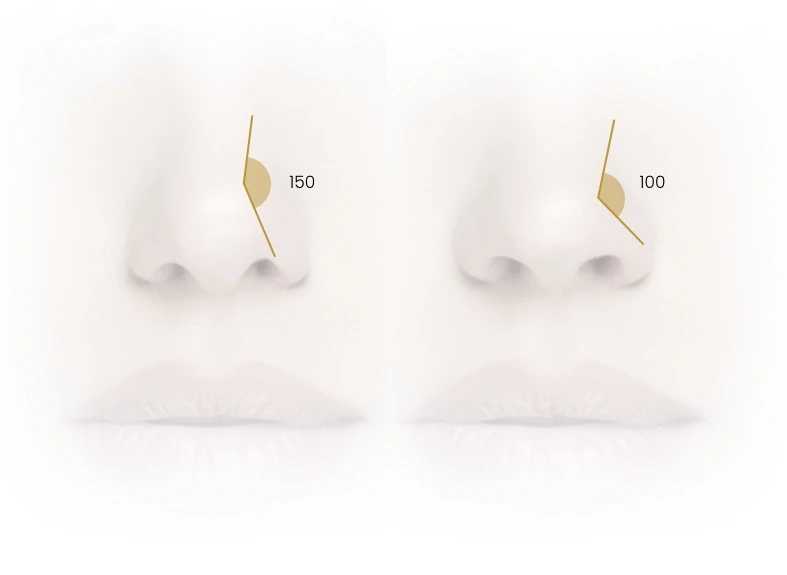 Advanced Pinched Tip Nasal Correction | NYC & Manhattan